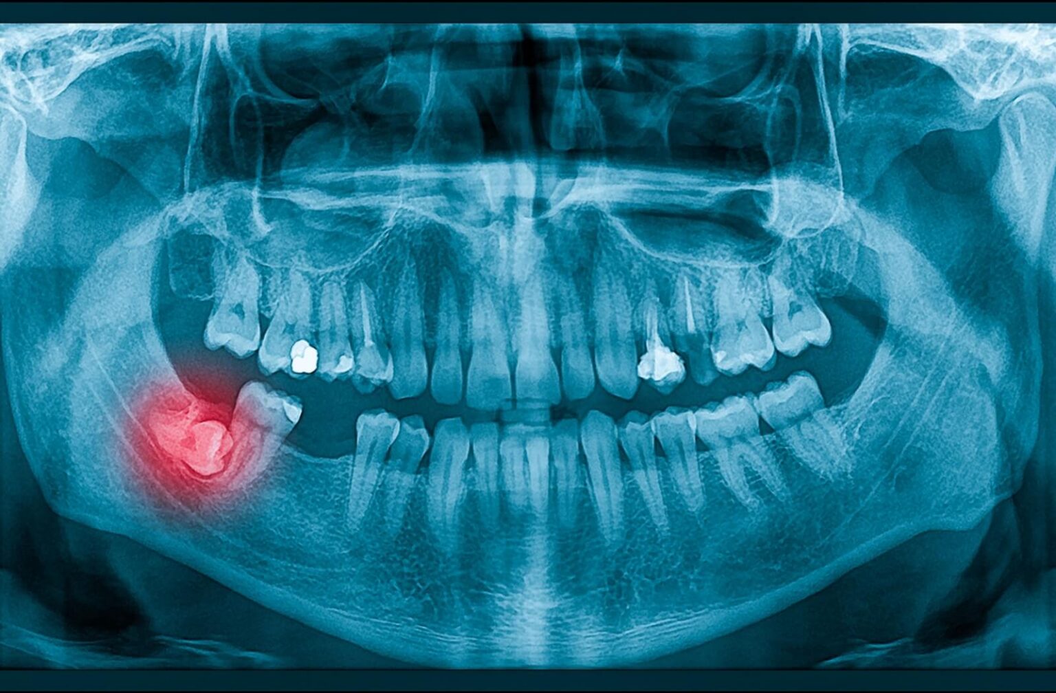 When Do Wisdom Teeth Grow In? 5 Signs to Watch For | The Top Dentists ...